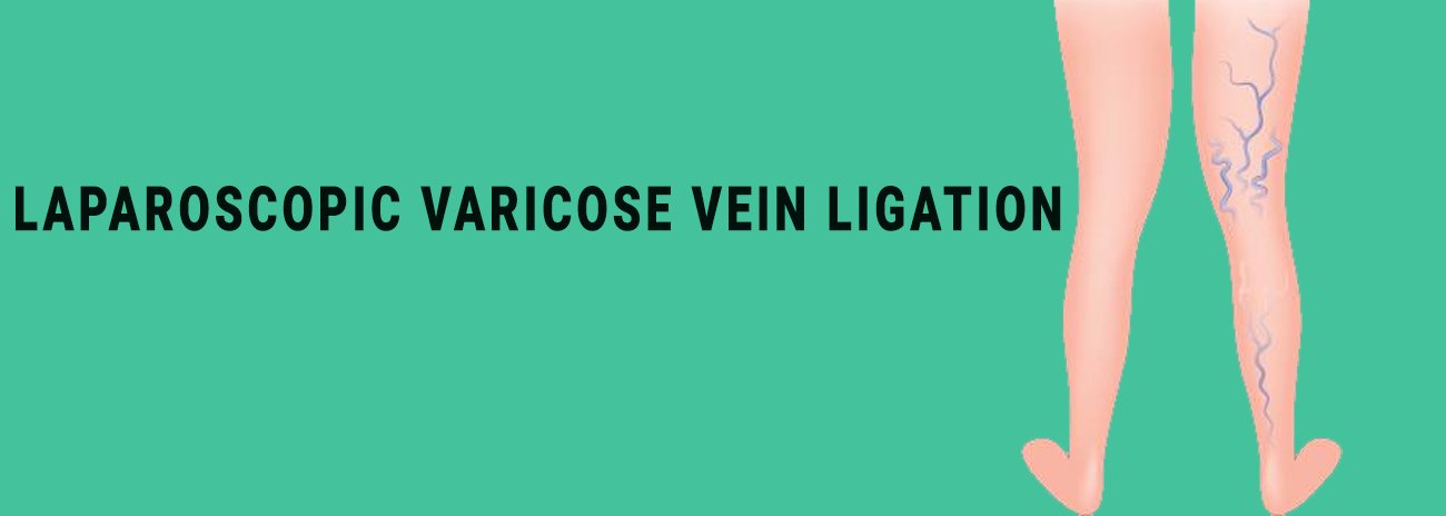 Laparoscopic Varicose Vein Ligation - Dr. Gaurav Mishra | General ...