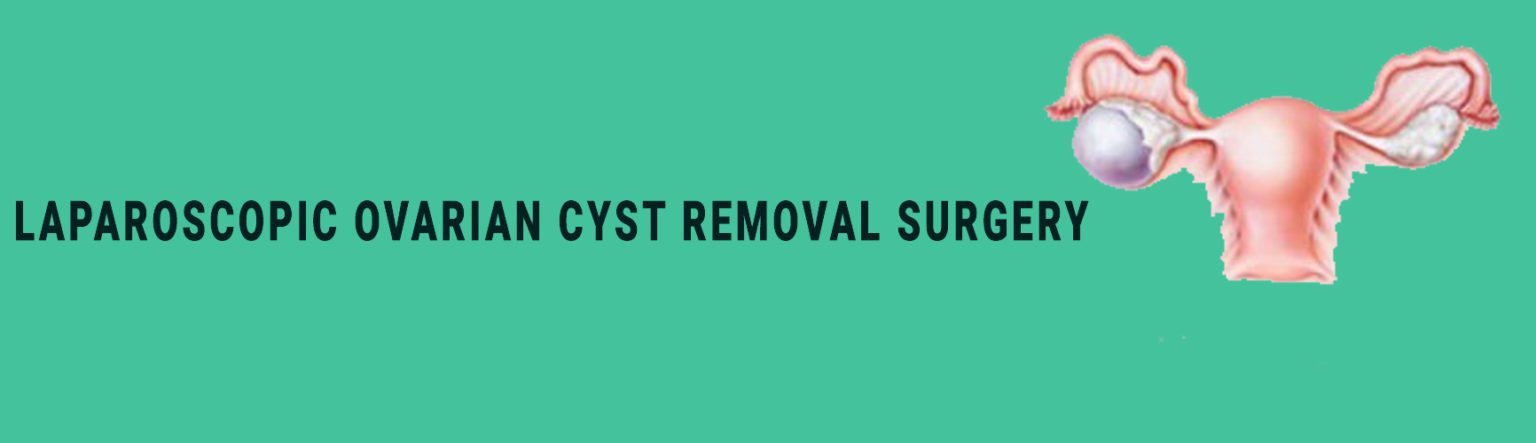 Laparoscopic Ovarian Cyst Removal Surgery - Dr. Gaurav Mishra | General ...